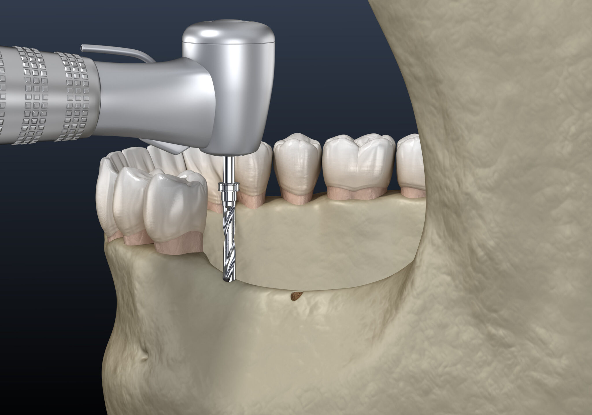 Rebuilding Jaw Structure With Grafting | Newport Beach, CA